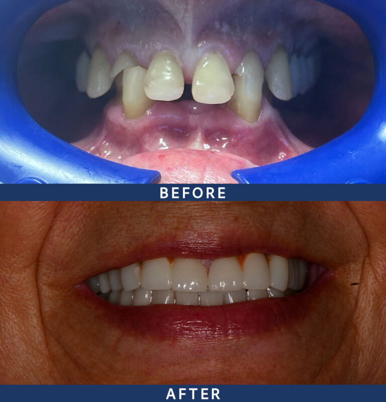 Before & After Photos | Broadway Smile Boutique | Pasadena & Burbank, CA