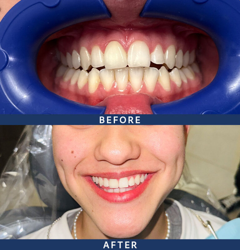 Before & After Photos | Broadway Smile Boutique | Pasadena & Burbank, CA